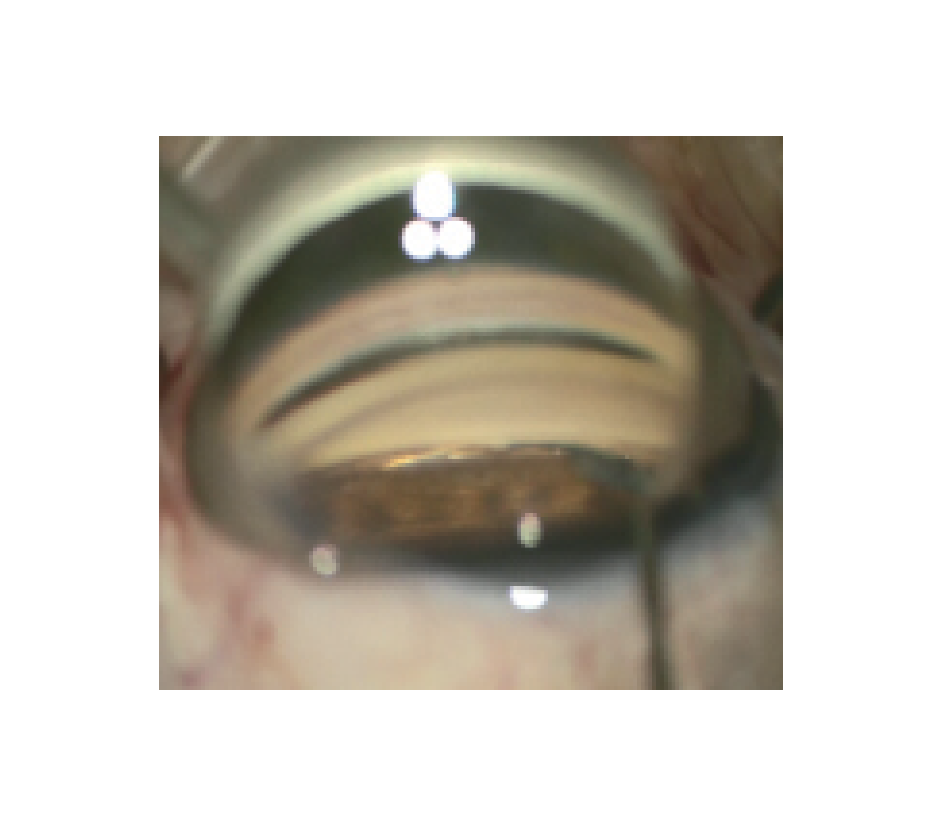 First 50 MIGS Procedures as a Glaucoma Fellow - Glaucoma Today