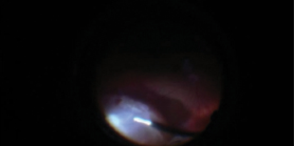 Passive Shaving: A Novel Approach for a Mobile Retina - Retina Today