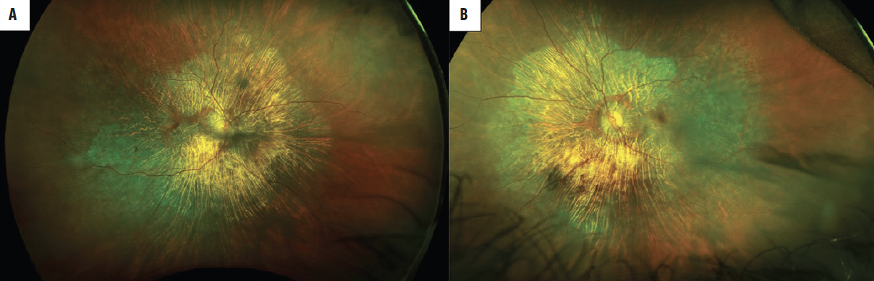 Thioridazine Retinal Toxicity - Retina Today