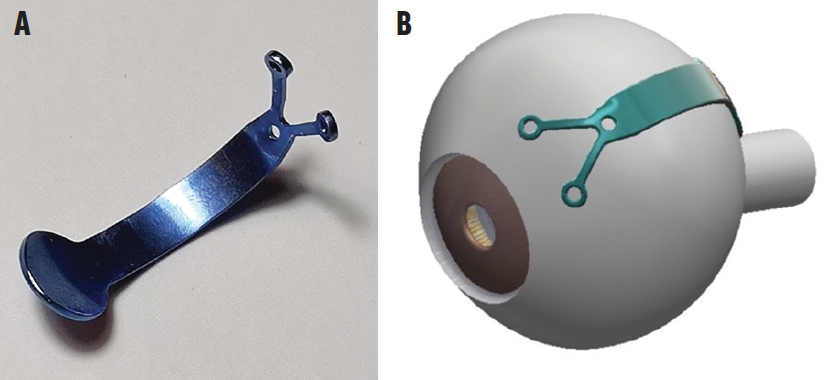 Macular Buckling for Myopia: A Novel Approach - Retina Today