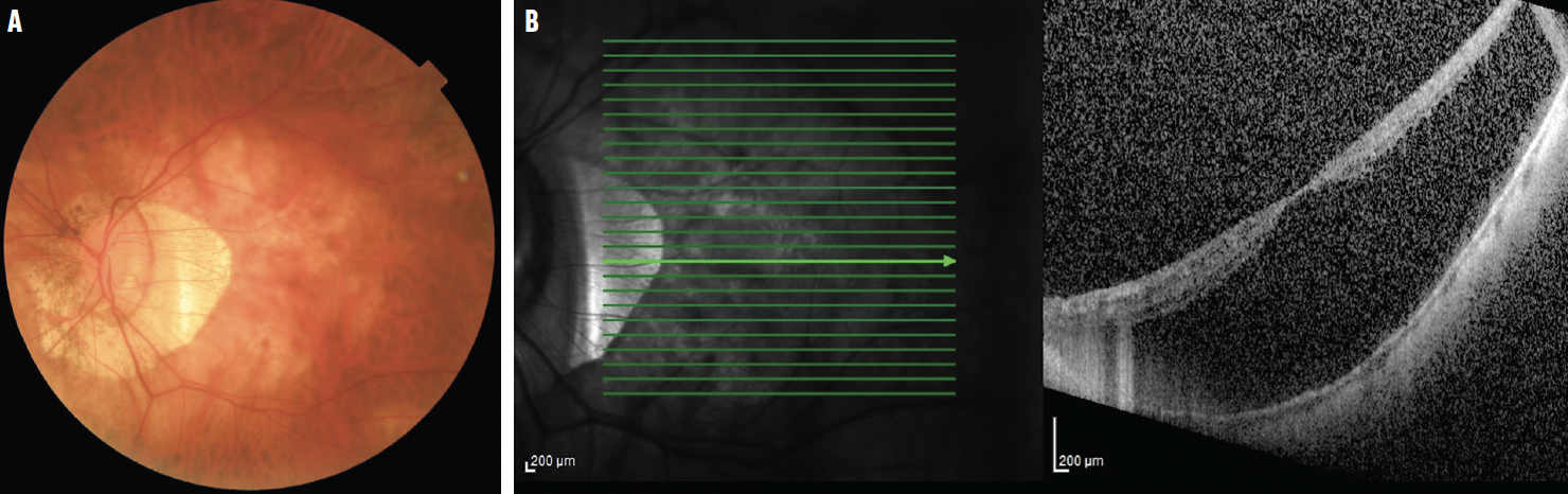 Macular Buckling for Myopia: A Novel Approach - Retina Today