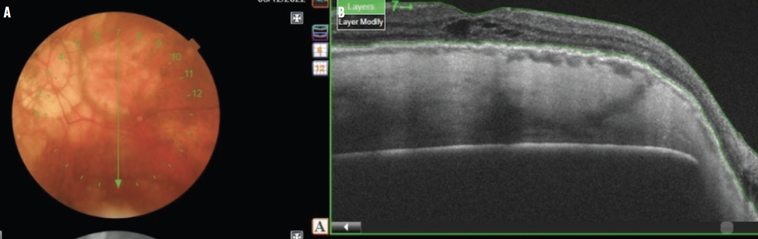 Macular Buckling for Myopia: A Novel Approach - Retina Today