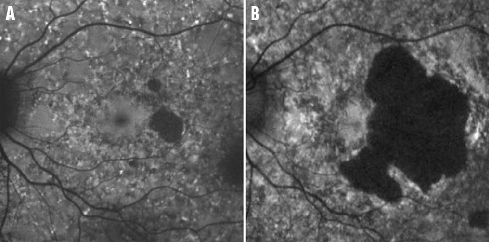 Fundus Autofluorescence For IRDs - Retina Today