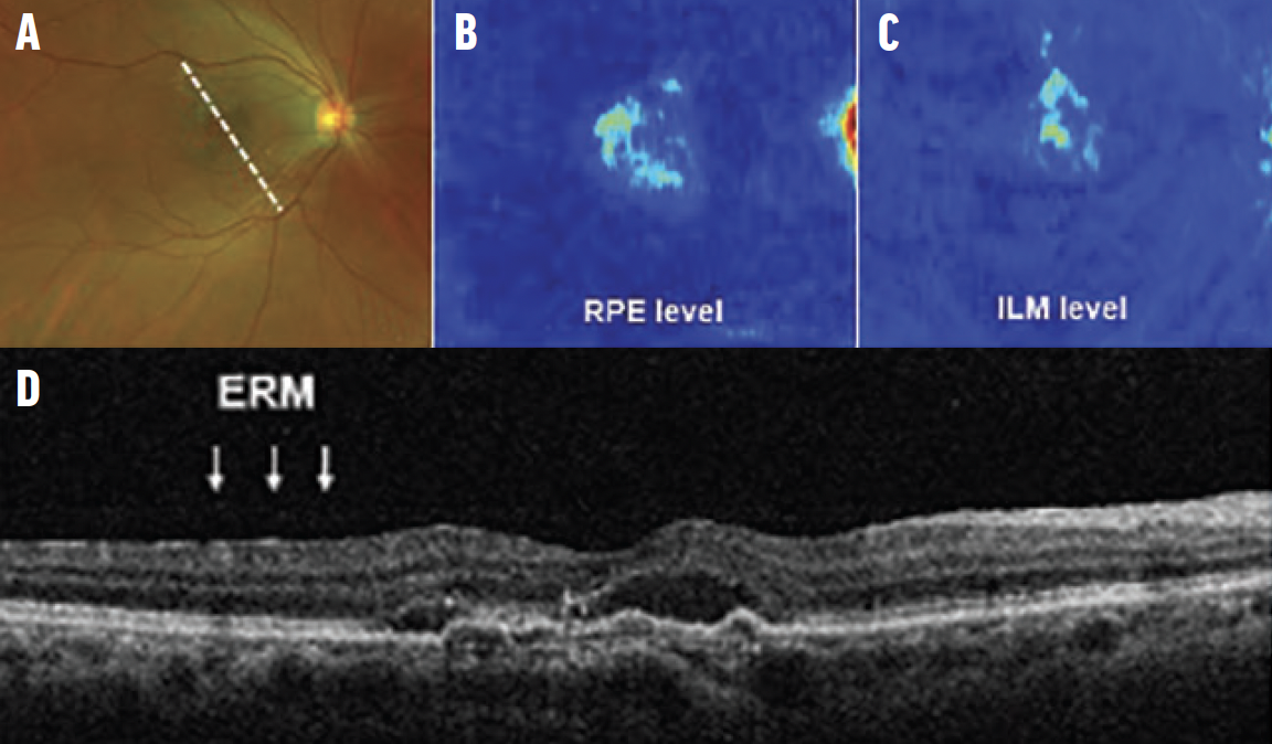 Wayfinding AI: A New Way to Detect Retinal Disease - Retina Today