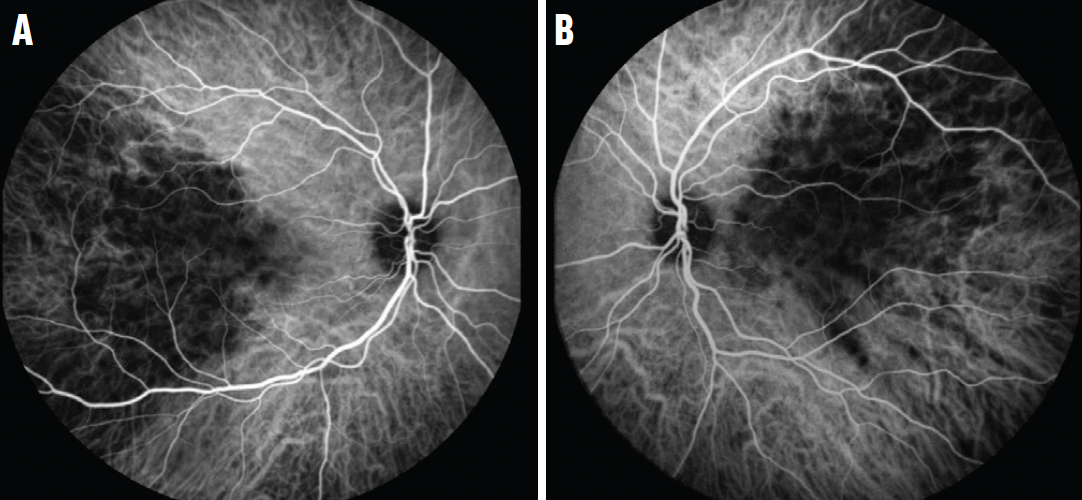 Choroidal Metastasis Associated With Oropharyngeal Carcinoma - Retina Today