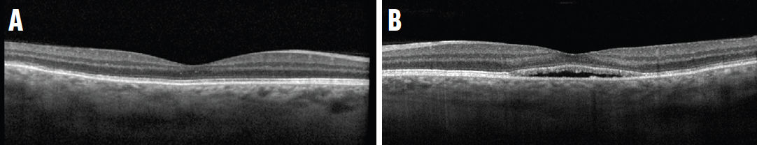 Choroidal Metastasis Associated With Oropharyngeal Carcinoma - Retina Today
