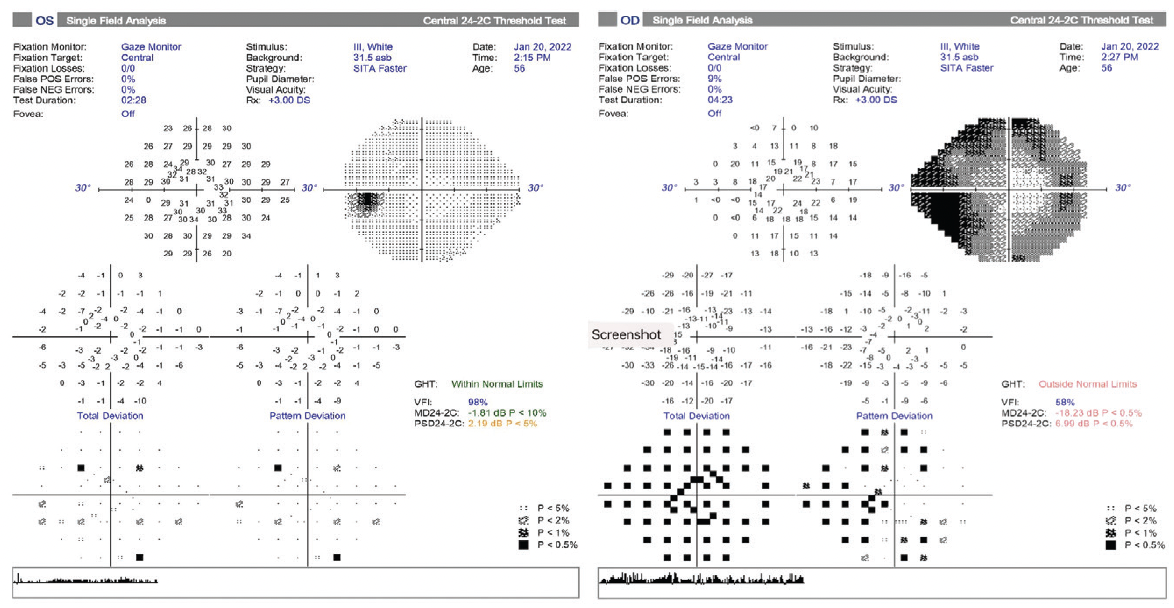 Unexpected Field Changes - Glaucoma Today