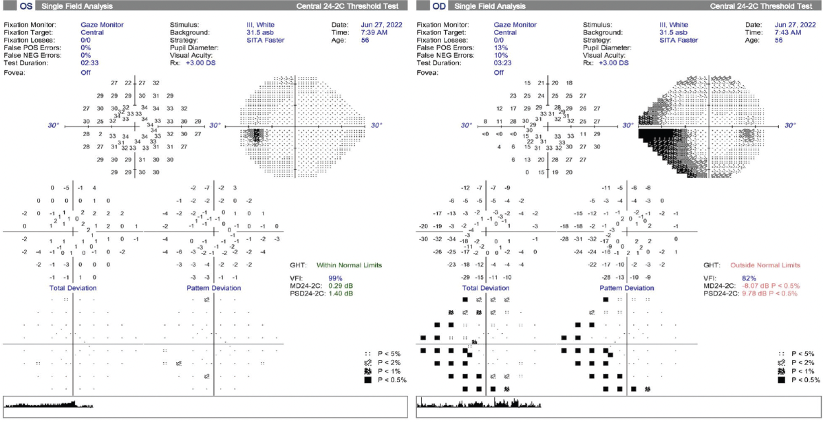 Unexpected Field Changes - Glaucoma Today