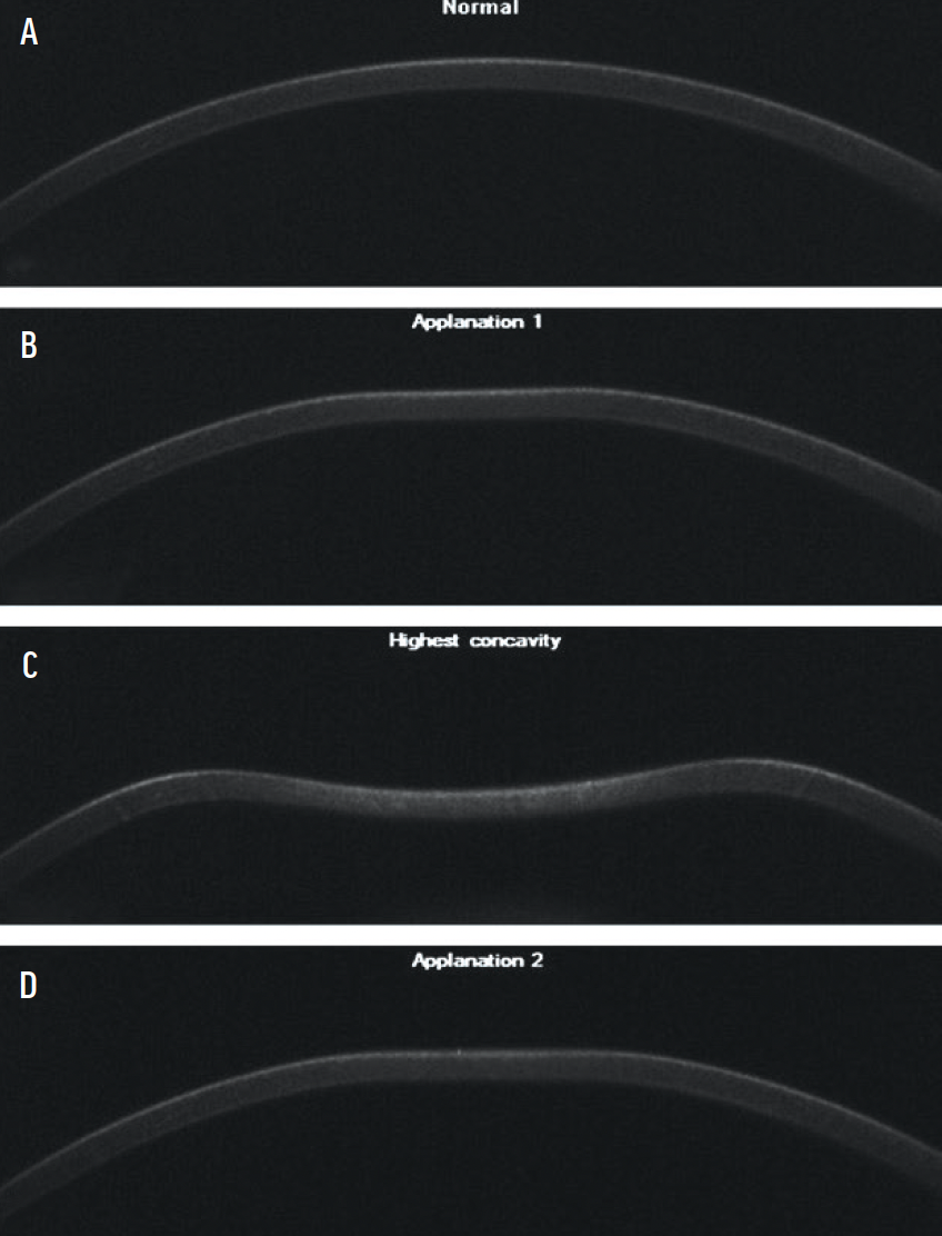 Corneal Biomechanics and Glaucoma - Glaucoma Today