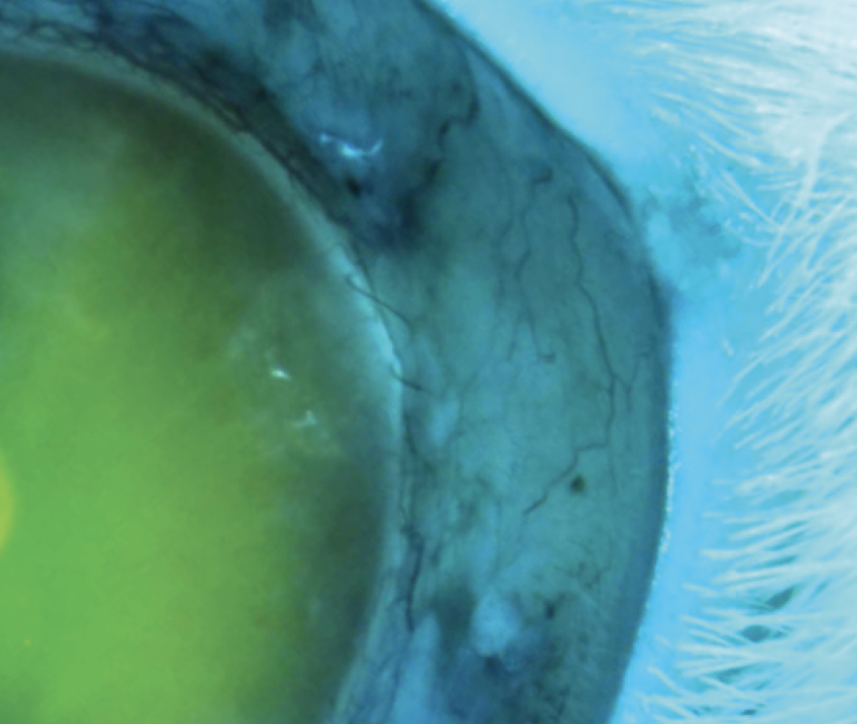 A Multichannel Approach to a Better Bleb - Glaucoma Today