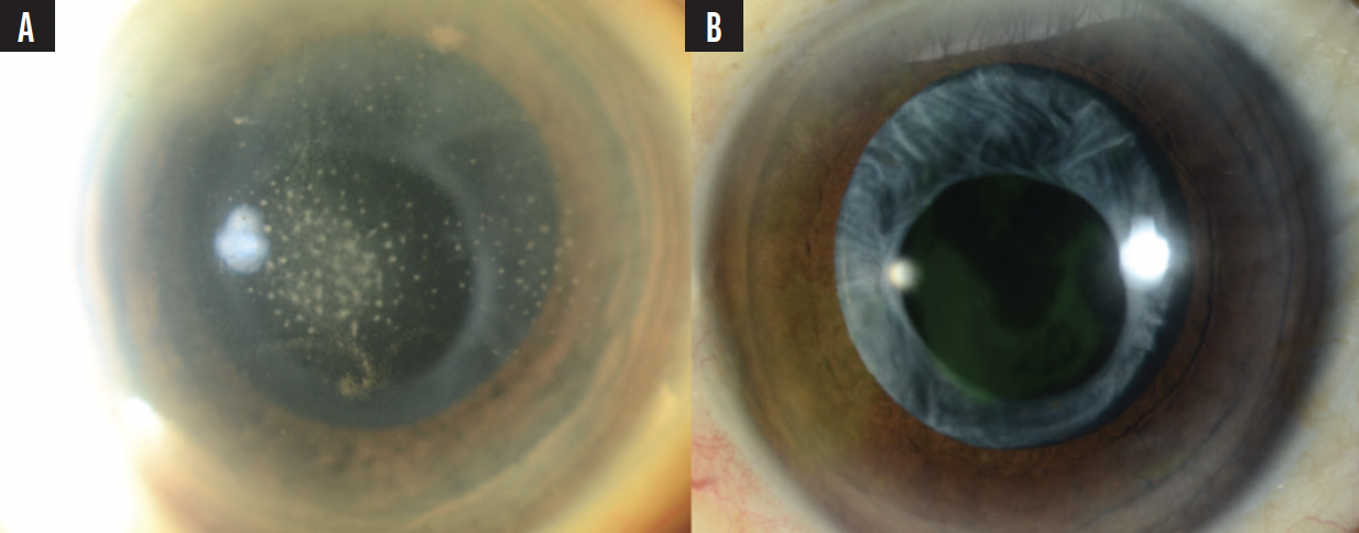 Treating Herpes Simplex and Varicella Anterior Uveitis - Glaucoma Today