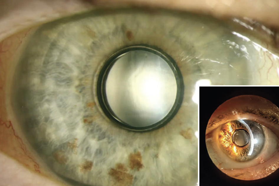 Macular Degeneration: Time to Focus on Vision - Retina Today