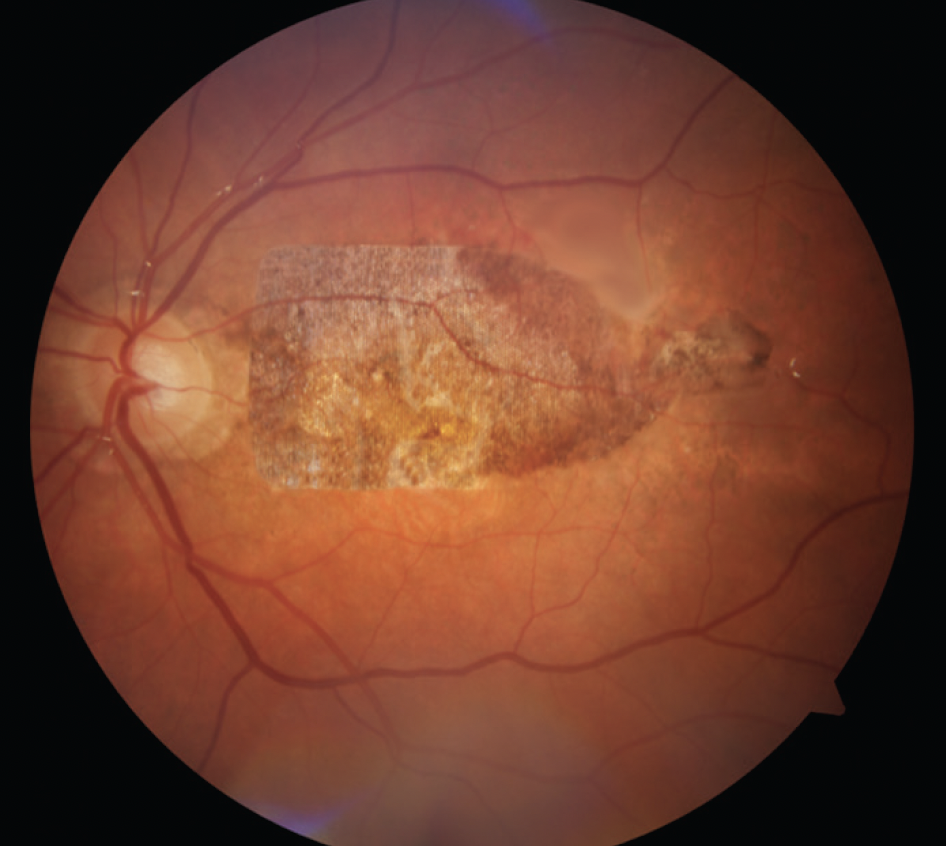 Macular Degeneration: Time to Focus on Vision - Retina Today