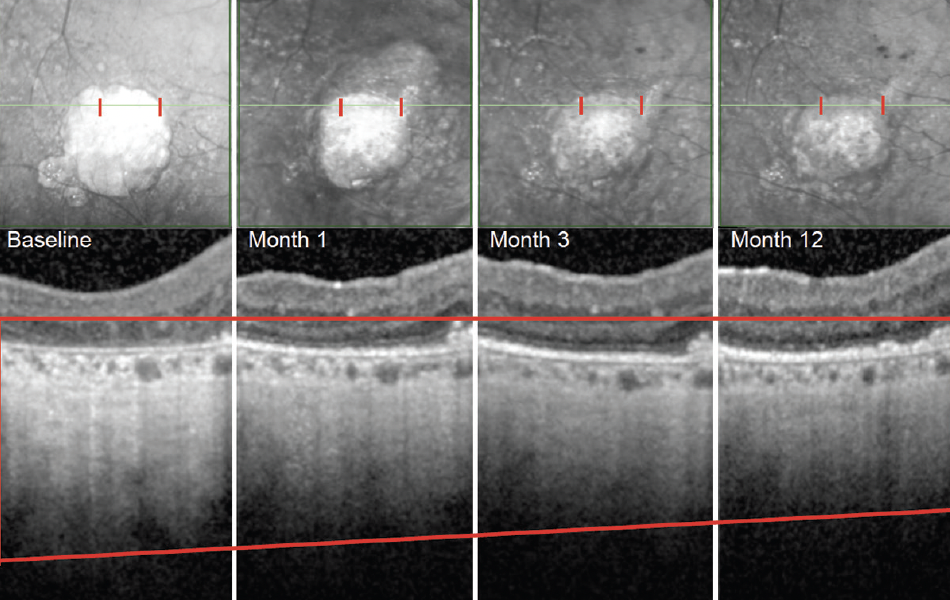 Macular Degeneration: Time to Focus on Vision - Retina Today