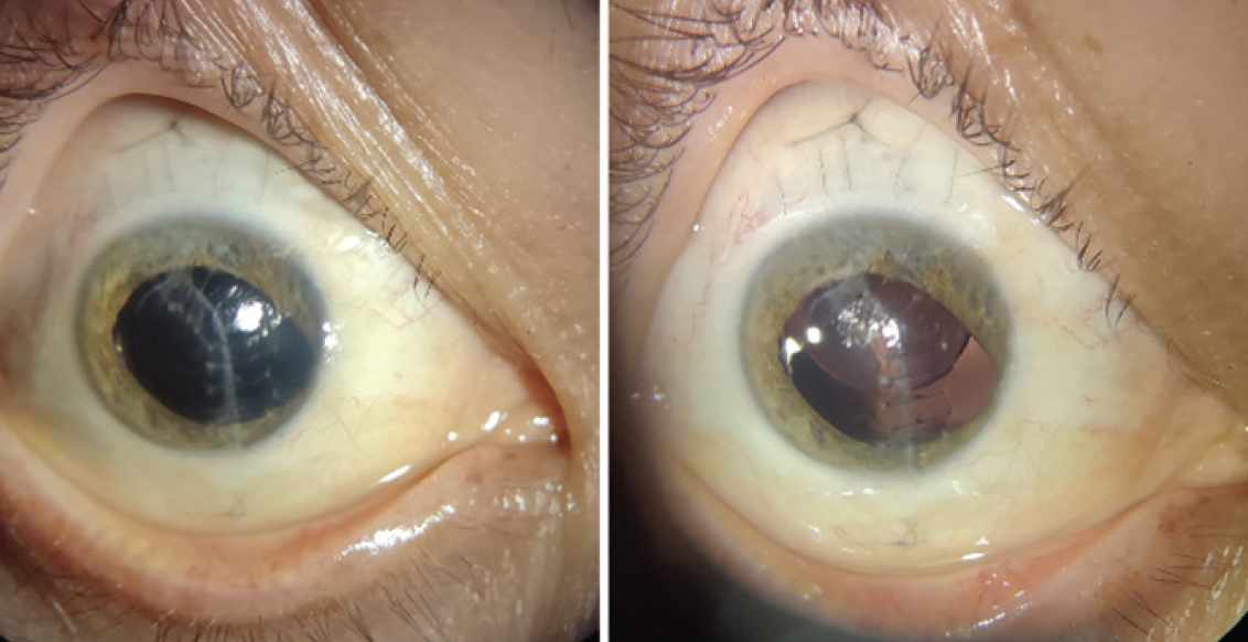 Surgical Technique for Scleral-Fixated IOLs - Retina Today