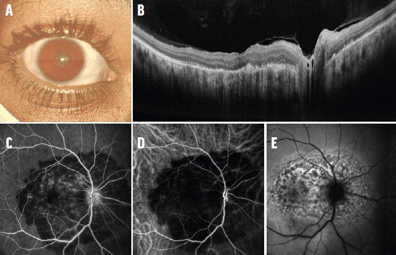 Diagnostic Yield in Non-Dilating Pupils - Retina Today