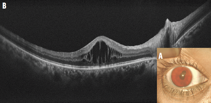Diagnostic Yield in Non-Dilating Pupils - Retina Today