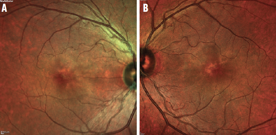 Beware of AMN With COVID-19 Infection - Retina Today
