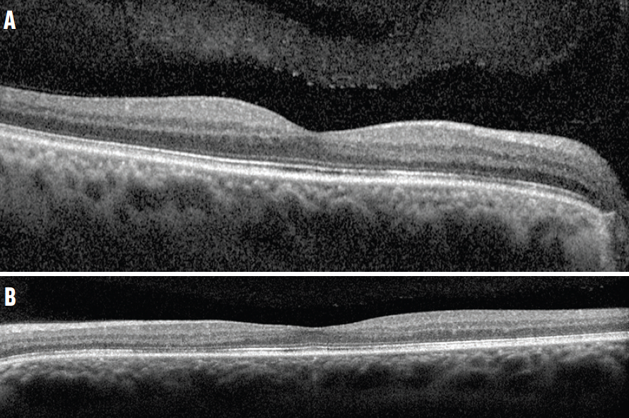 Beware of AMN With COVID-19 Infection - Retina Today
