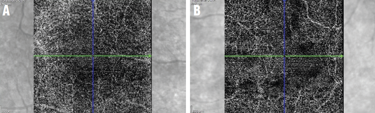 Beware of AMN With COVID-19 Infection - Retina Today