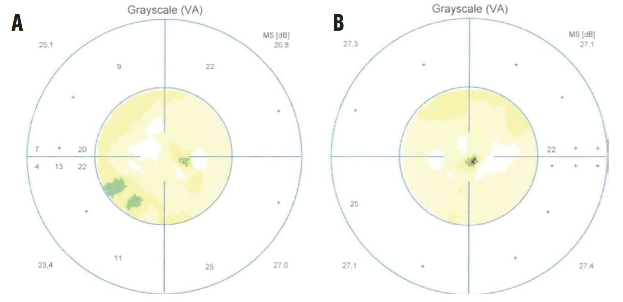 Beware of AMN With COVID-19 Infection - Retina Today