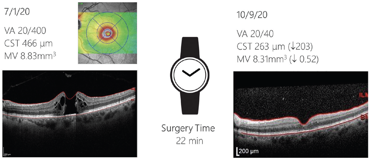 No More Forceps: A Cutter-based Approach to ILM Peeling - Retina Today