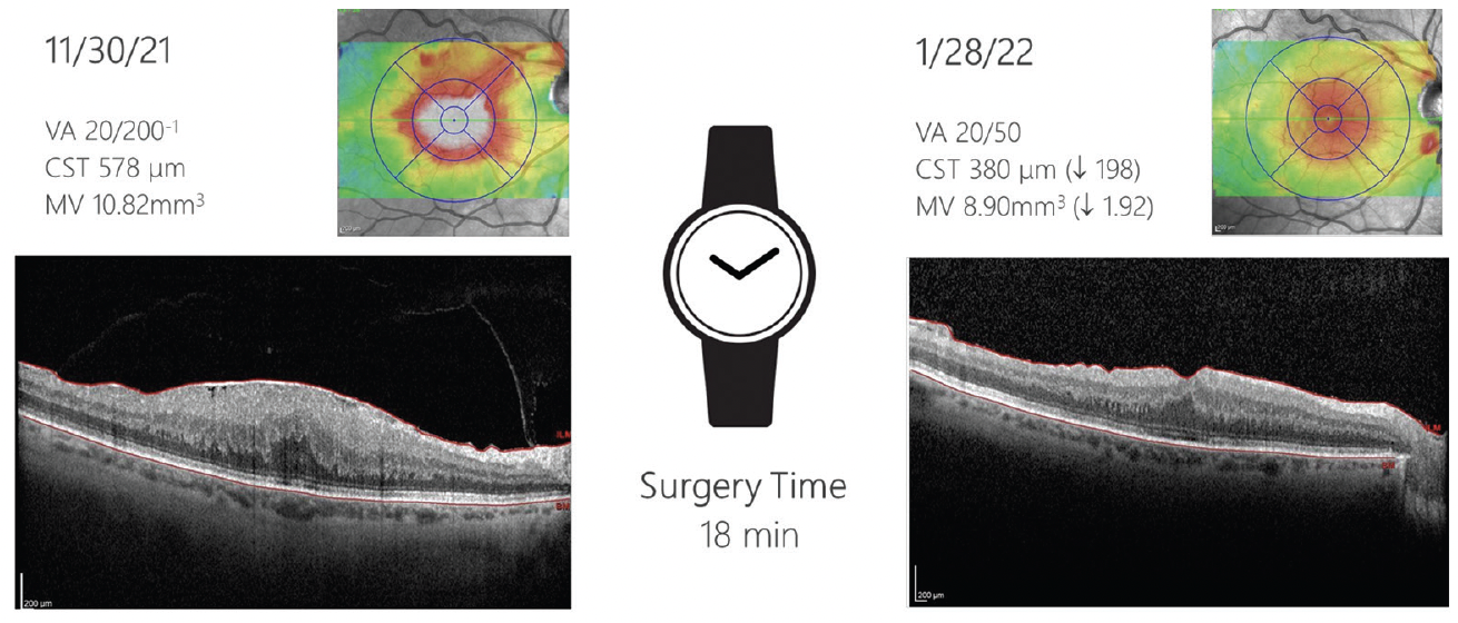 No More Forceps: A Cutter-based Approach to ILM Peeling - Retina Today