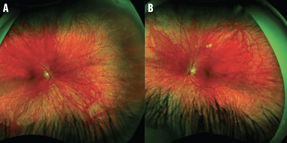 Retina Detectives: Mystery Cases - Retina Today