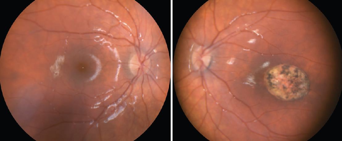 Global Retina Care: The Ukraine Experience - Retina Today