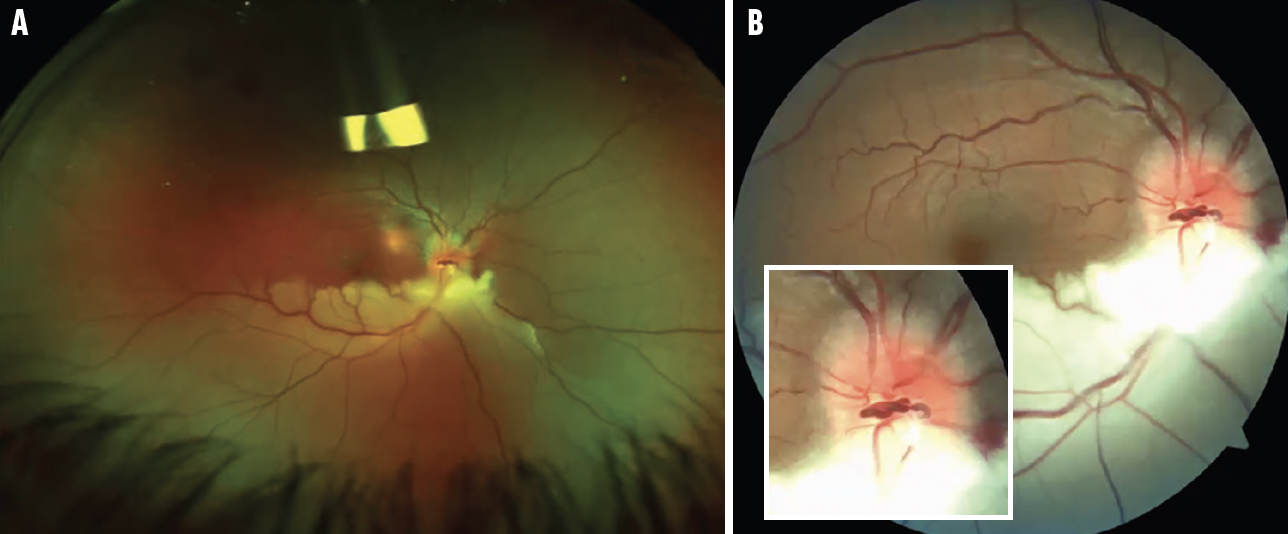 BRAO Associated With Prepapillary Vascular Loop - Retina Today