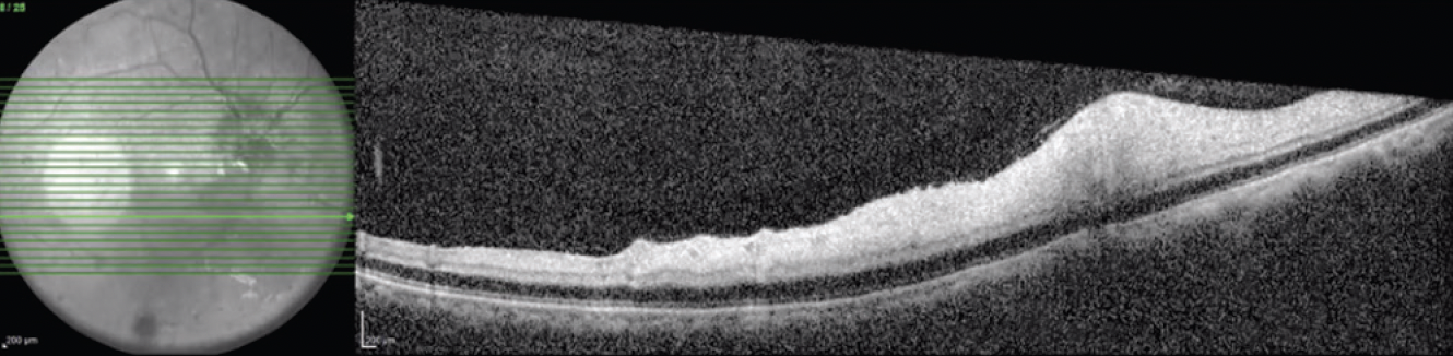 BRAO Associated With Prepapillary Vascular Loop - Retina Today