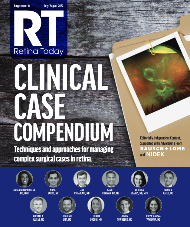 Scleral Buckle Placement Using Chandelier Illumination for a Macula ...