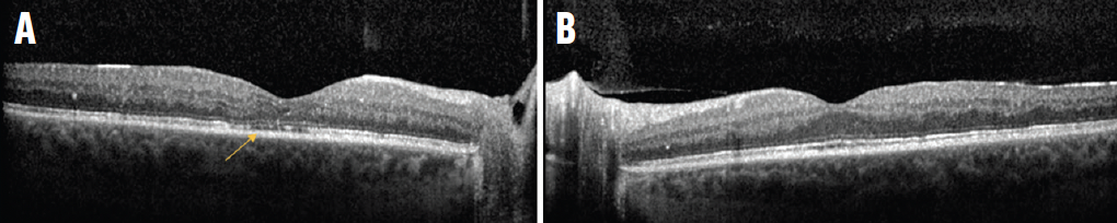 What to Look for With MODY - Retina Today
