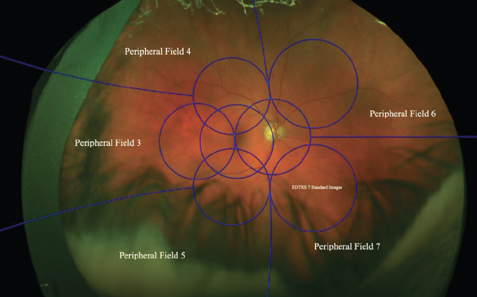 Assessing DR With Ultra-Widefield Imaging - Retina Today