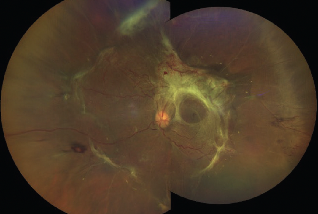 Your Complex TRD Questions Answered - Retina Today