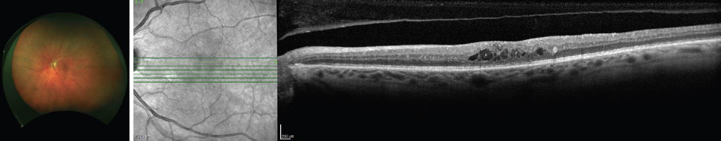 Behind the Curtain: Anti-VEGF Responses in DME - Retina Today