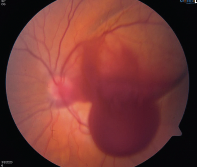 High-Altitude Retinopathy: A Review - Retina Today