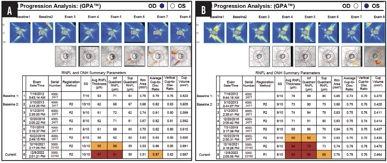 Progressive Glaucoma and a Desire for Perfect Vision - Glaucoma Today