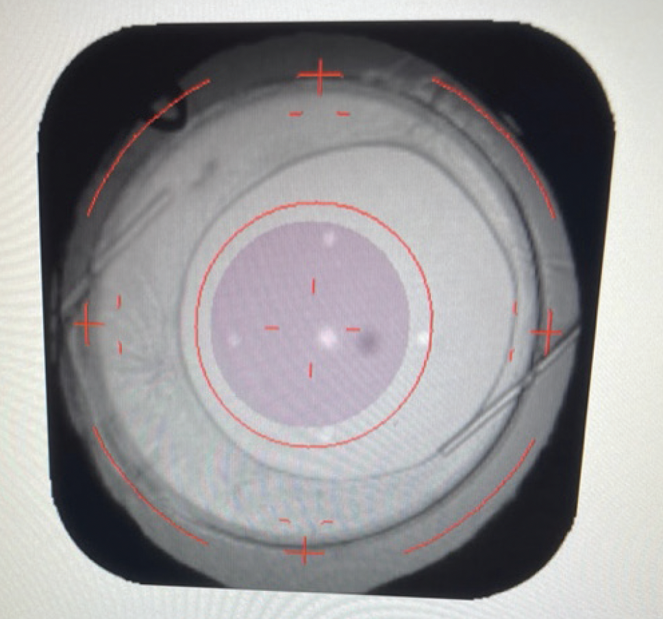 Progressive Glaucoma and a Desire for Perfect Vision - Glaucoma Today