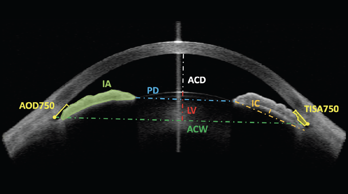 Personalizing Angle-Closure Care - Glaucoma Today