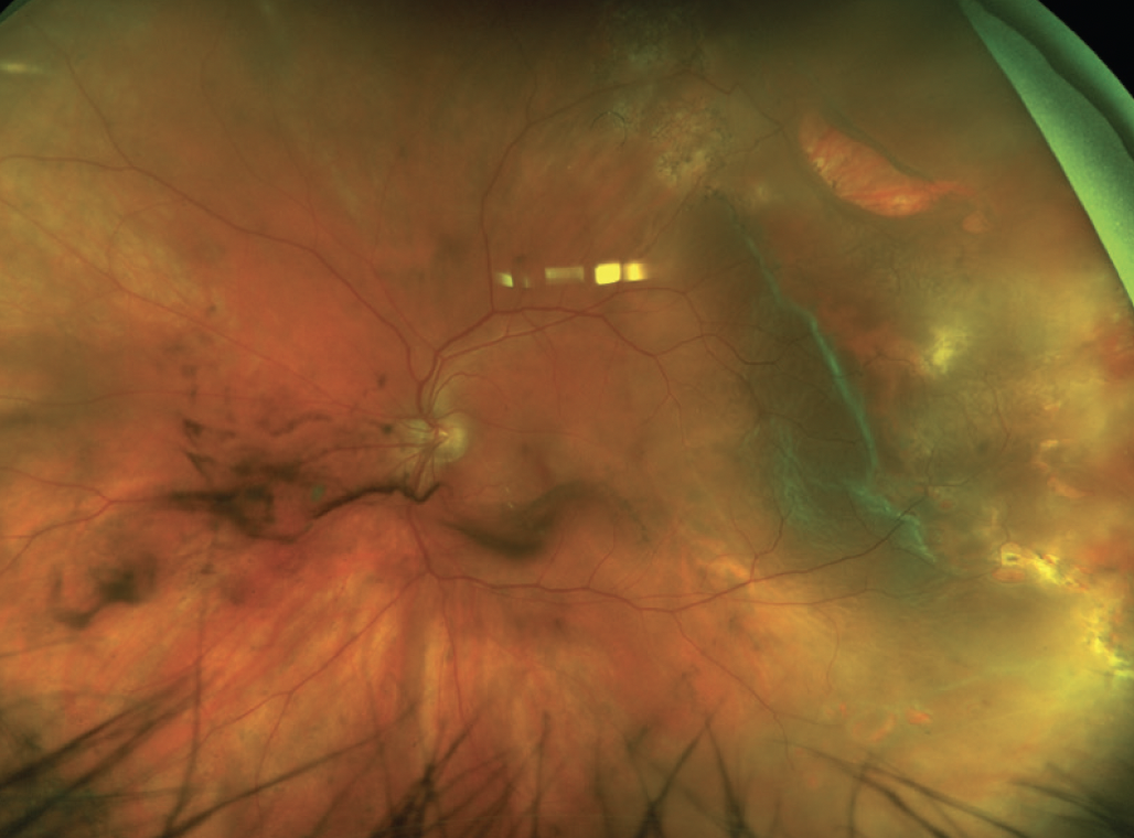 New Concepts in Proliferative Vitreoretinopathy - Retina Today