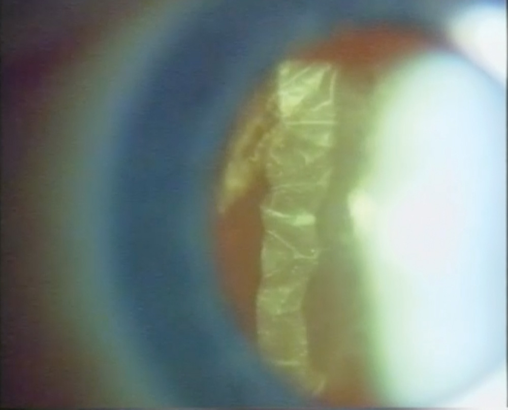 Managing Vitreous Floaters - Retina Today