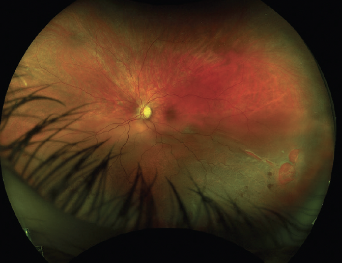 How to Choose Wisely: PPV, SB, or Both - Retina Today