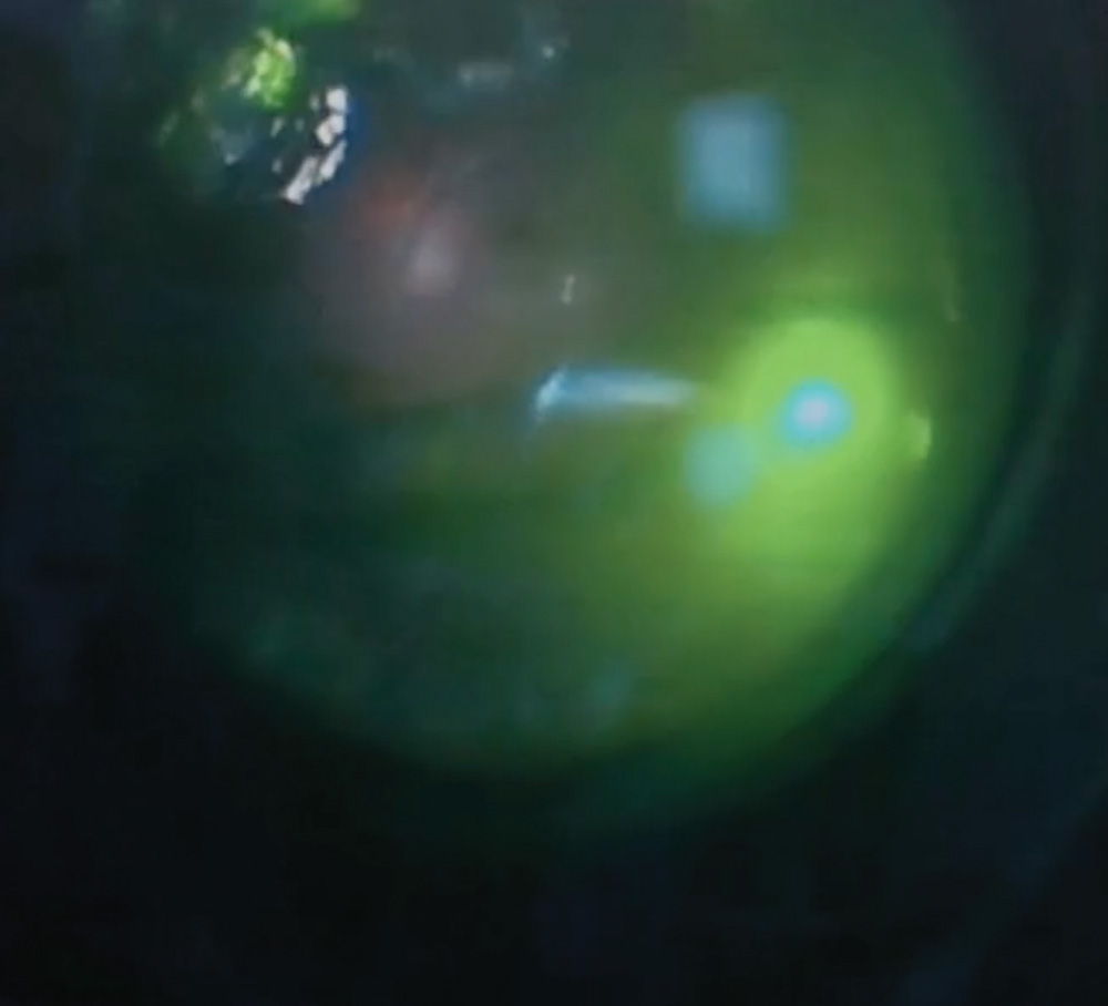 The Benefits of 360° Laser Retinopexy After Vitrectomy - Retina Today