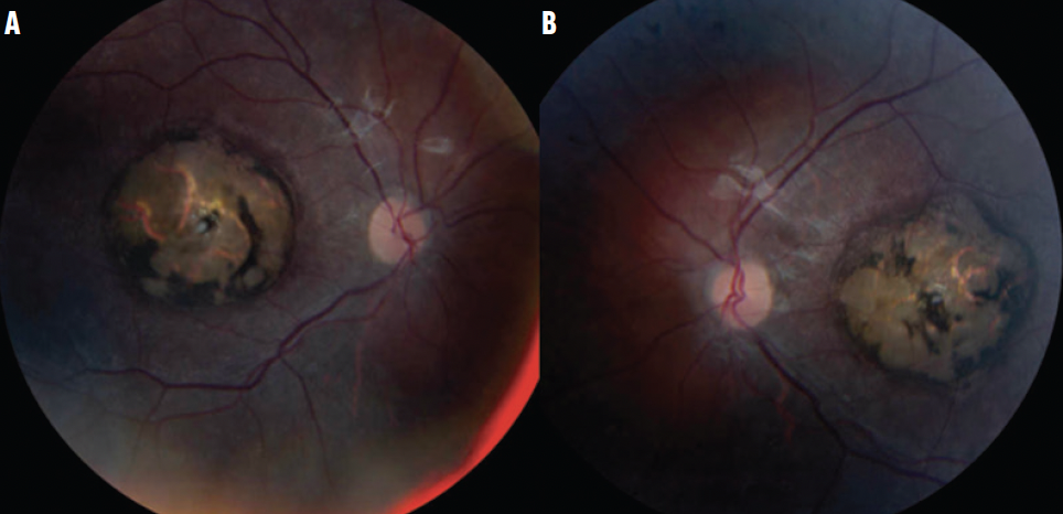 Ocular Manifestations of Cobalamin C Deficiency - Retina Today