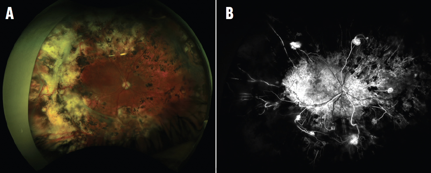 Retinal Capillary Hemangioblastomas in VHL - Retina Today