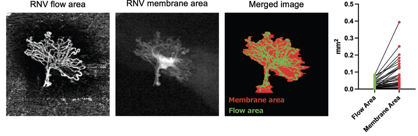 The Utility of En Face OCT for Detecting Neovascularization in DR ...