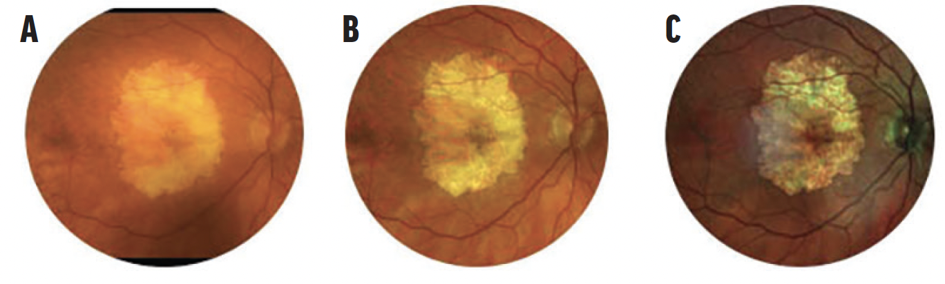 Capturing Geographic Atrophy with Multimodal Imaging - Retina Today