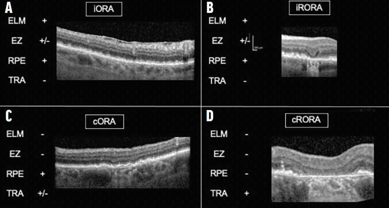 Capturing Geographic Atrophy with Multimodal Imaging - Retina Today