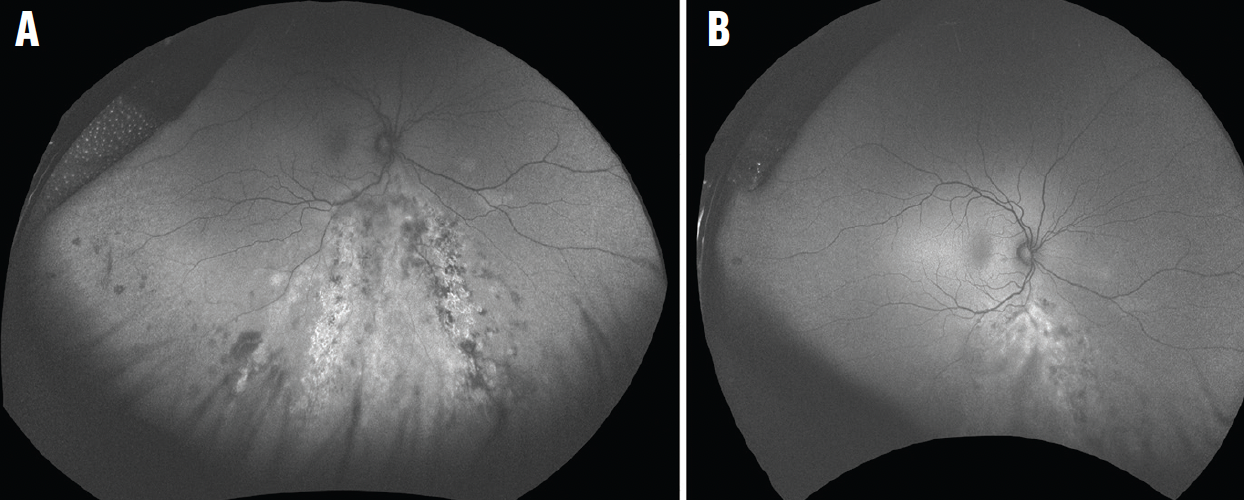 Multimodal Imaging in Uveitis - Retina Today